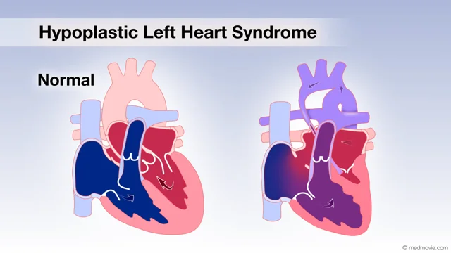 Hypoplastic Left Heart Syndrome