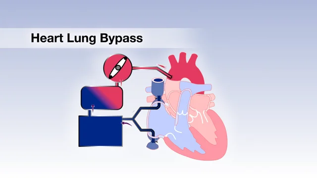 Cardiopulmonary Bypass Machine