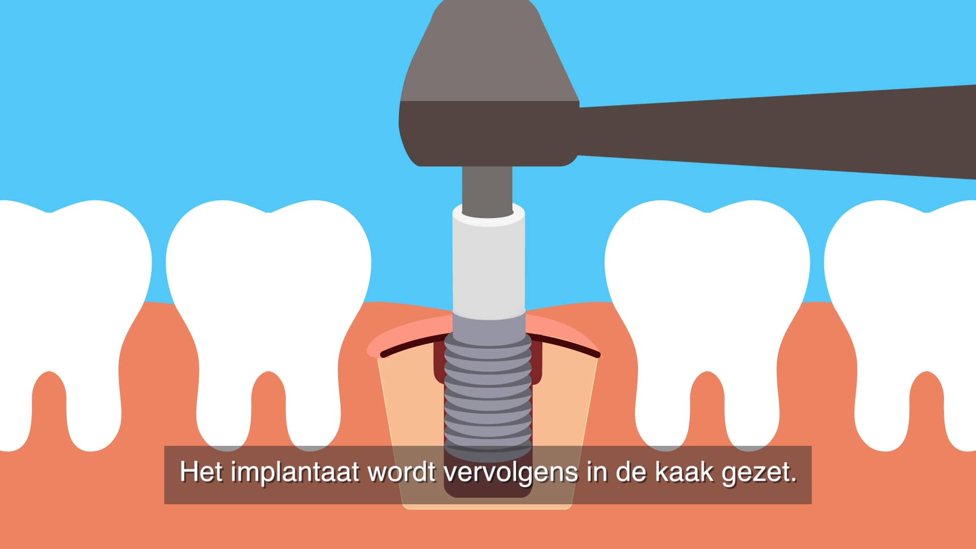 Een implantaat zetten on Vimeo