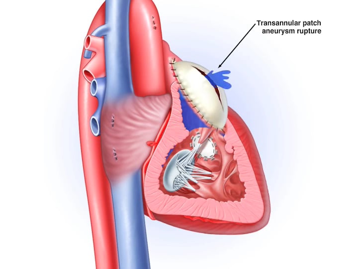 Tetralogy of Fallot Animation - Part 4 - Rupture of Bovine Transannular ...