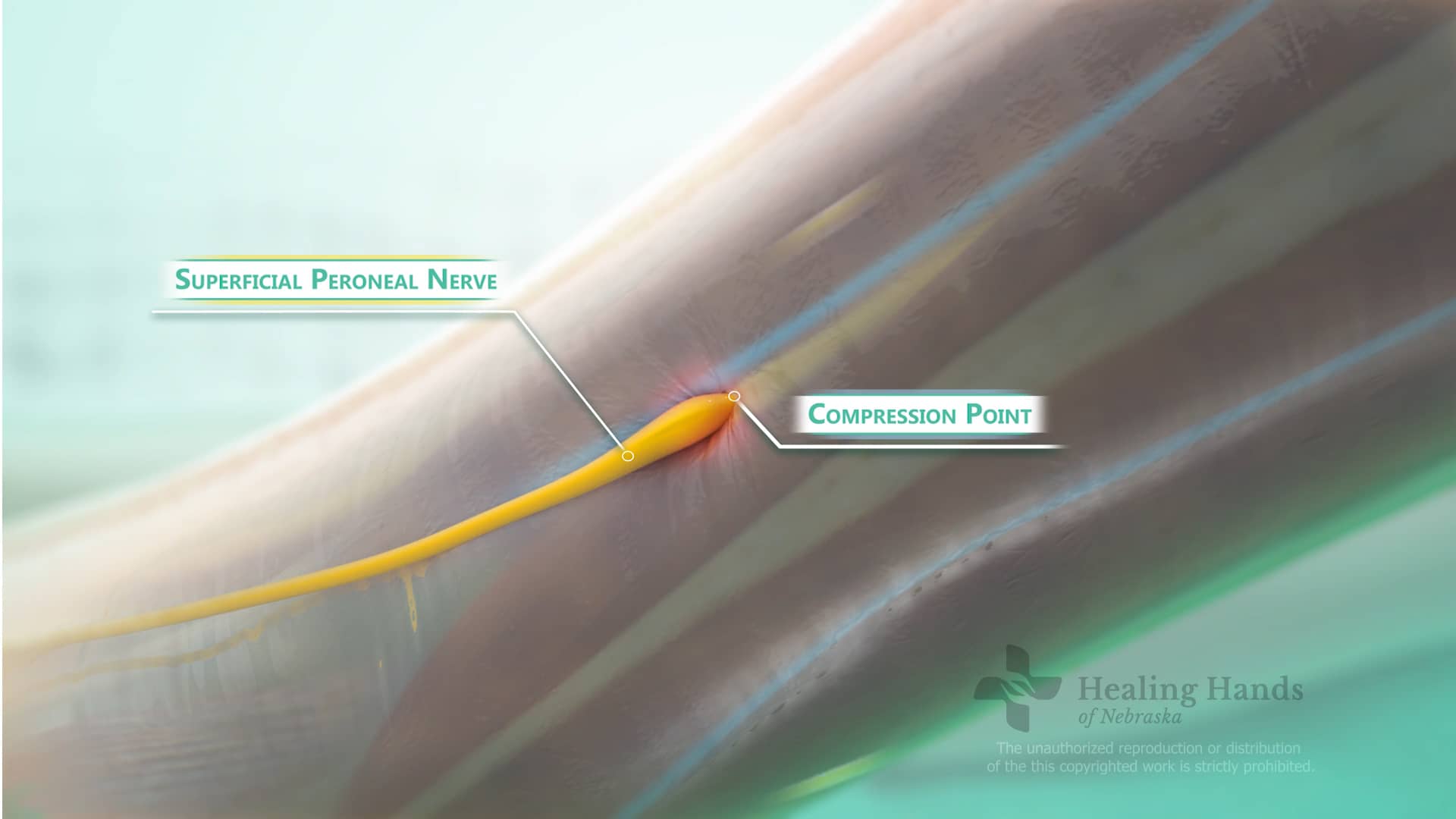Distal Superficial Peroneal Nerve Decompression | Single Cell Animation ...