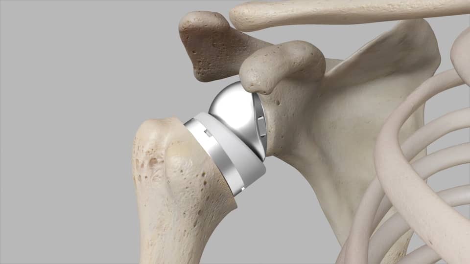 Exactech Reverse Shoulder Replacement Patient Animation on Vimeo