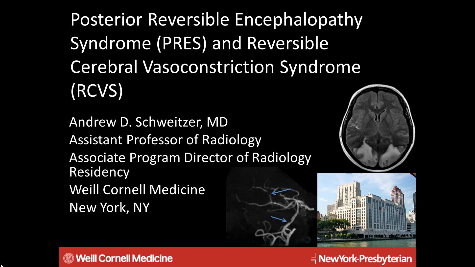 Neurocurriculum Live: Posterior Reversible Encephalopathy Syndrome ...