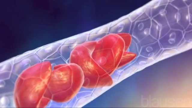Sickled Red Blood Cells