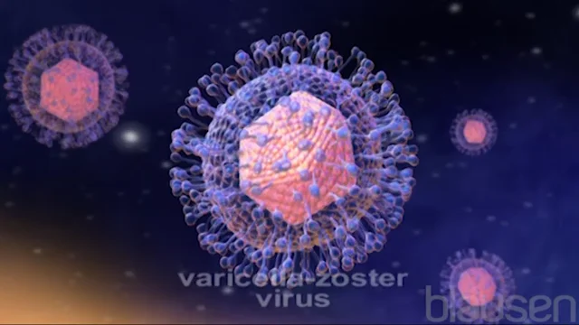 Chicken Pox Virus