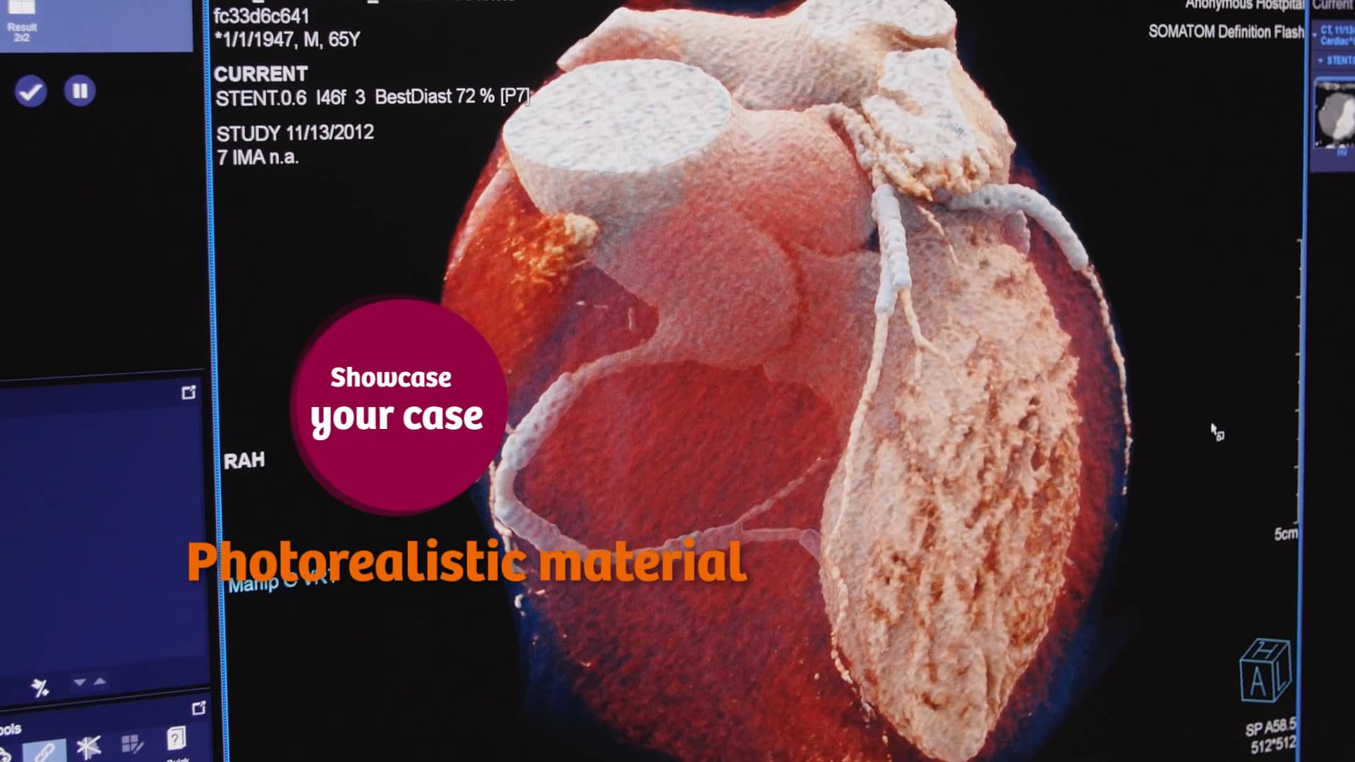 SIEMENS - Syngo.Via Imaging-Software // Produktvideo on Vimeo