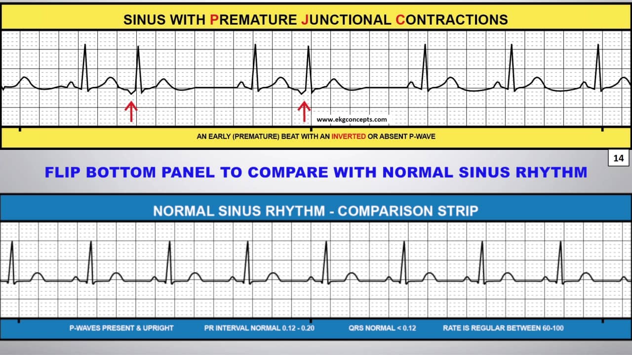 14-Premature Junctional Contraction on Vimeo