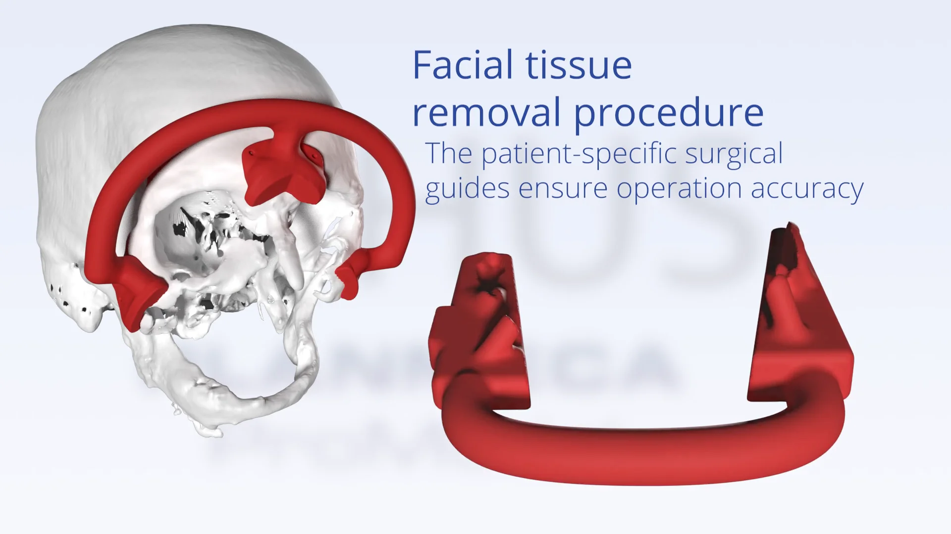 The second face transplant in the Nordics on Vimeo