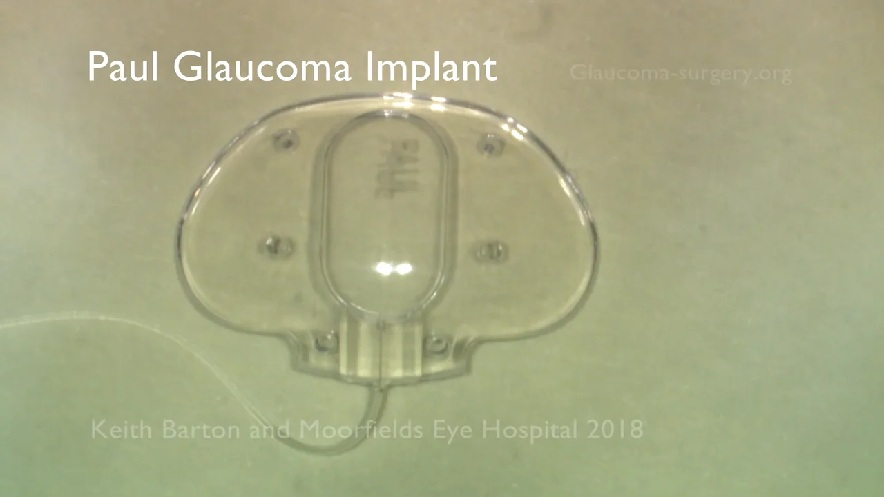 Paul Glaucoma Implant