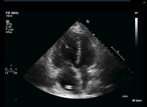 RV dilation on Vimeo