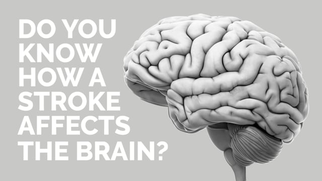 Human Brain After Stroke