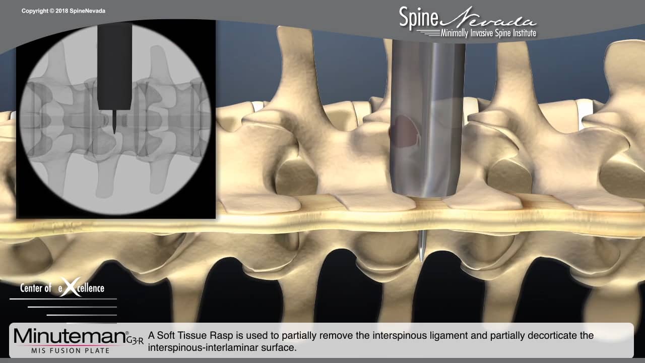 SpineNevada first in Nevada to use Spinal Simplicity Minuteman G3R MIS ...