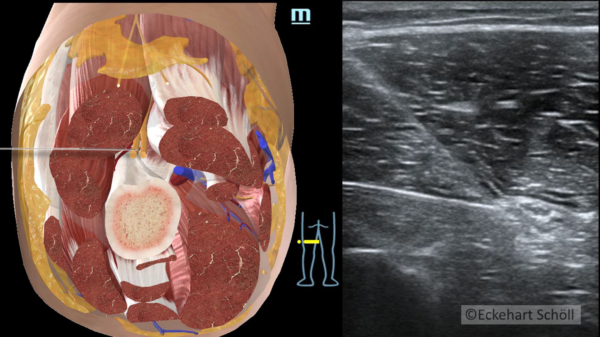 Ischiadicus-Blockade on Vimeo