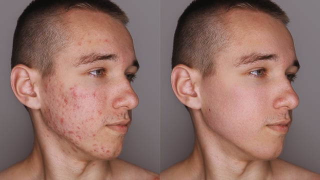 How to Treat Acne... with Visual Effects