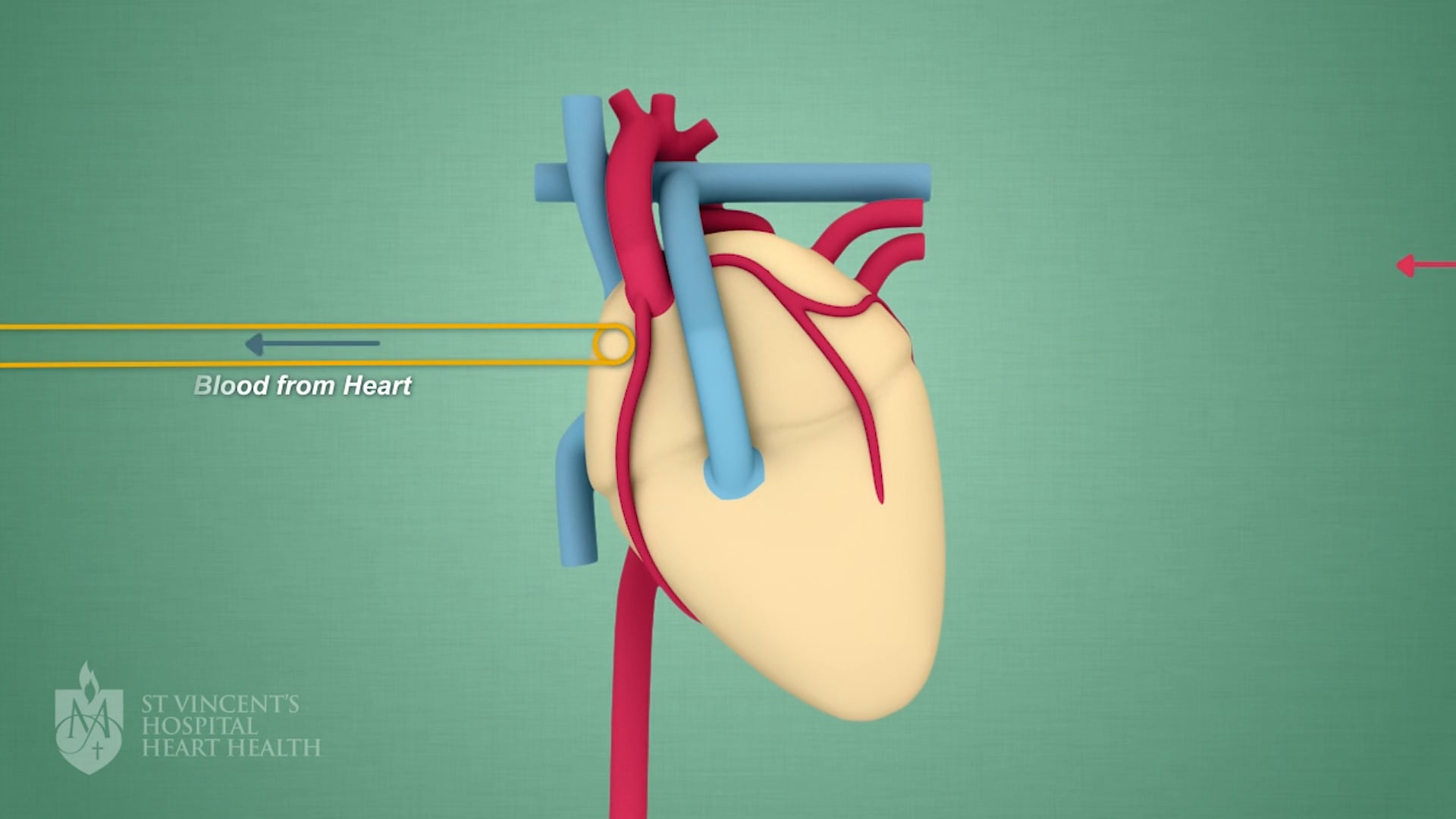 SVH Heart Health: Bridging the Gap for Heart Disease Patients on Vimeo