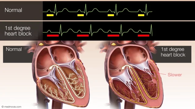 Ventricular Fibrillation Gif