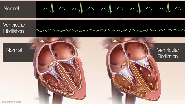 Ventricular Fibrillation Animation
