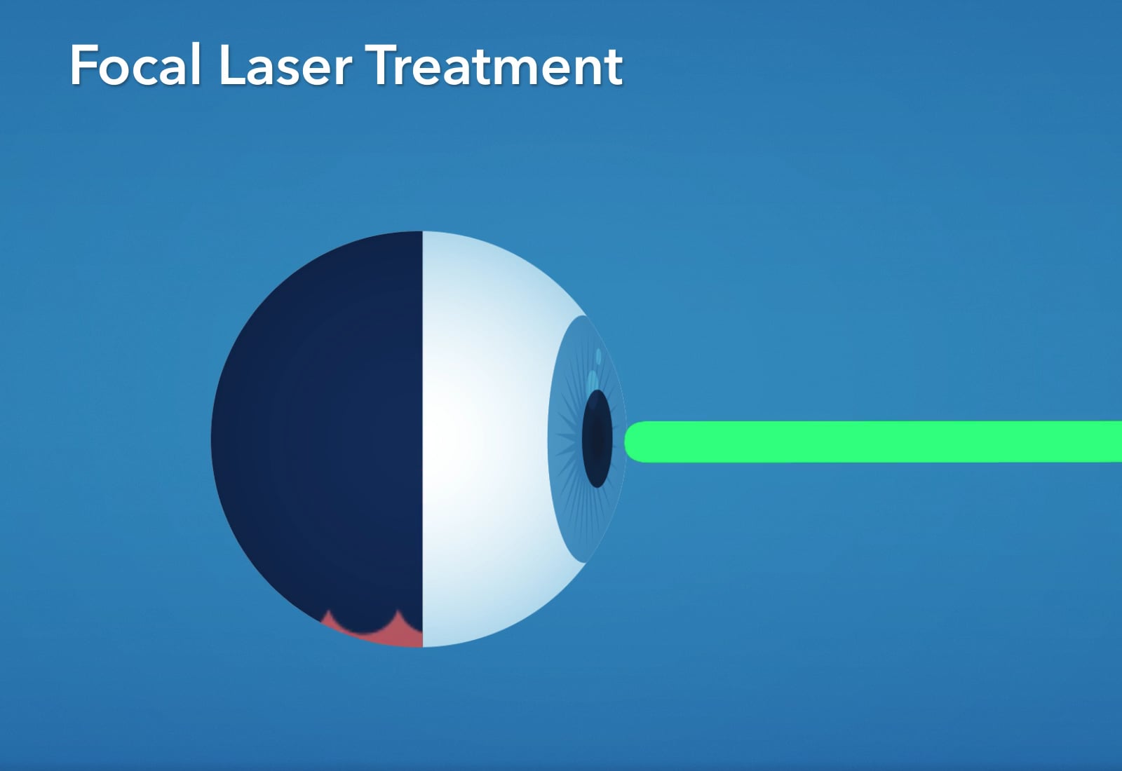 Diabetic Retinopathy - Focal Laser Treatment on Vimeo