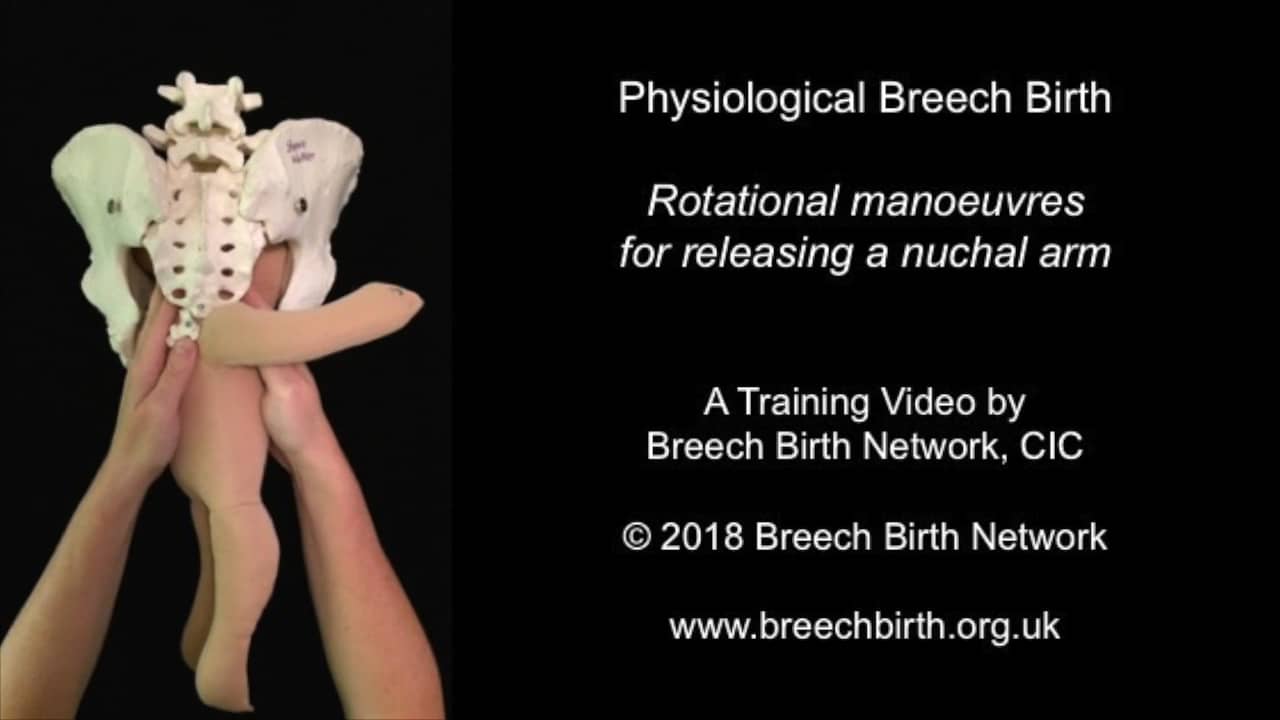 Nuchal Arm Release - Rotational Manoeuvre on Vimeo