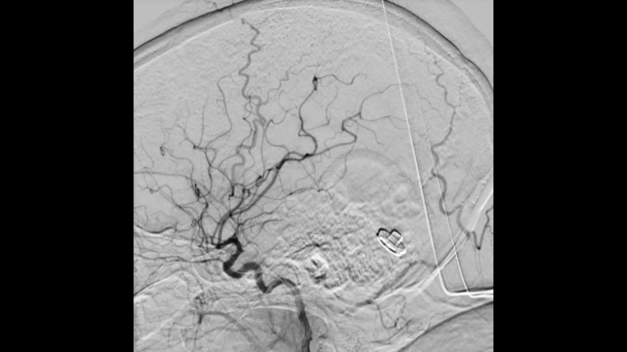 Right ICA injection, lateral view on Vimeo