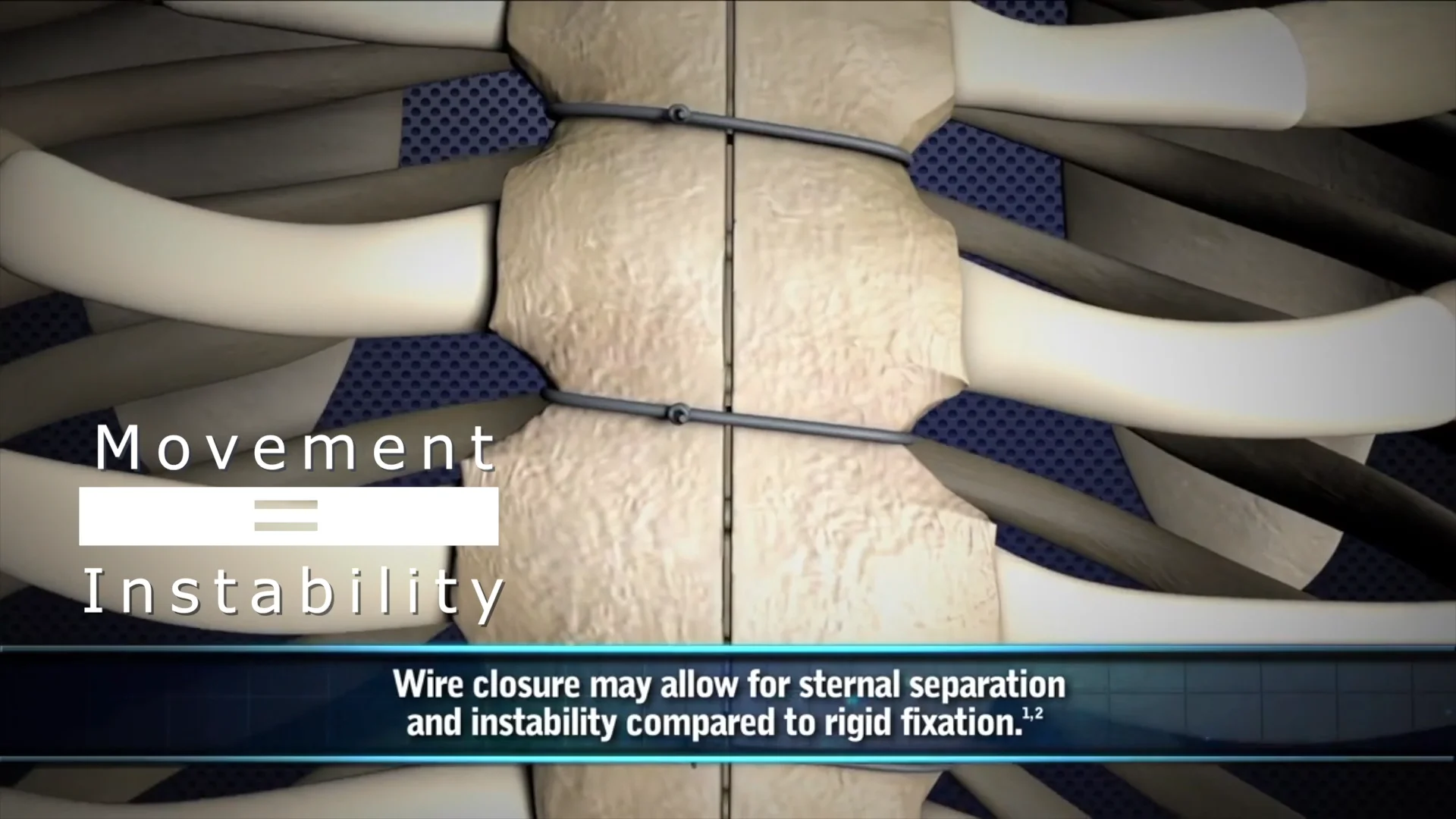 Sternal Closure Methods Animation | Zimmer Biomet on Vimeo