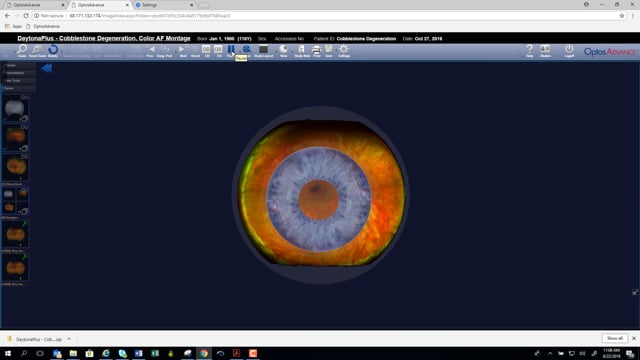 Cobblestone Degeneration