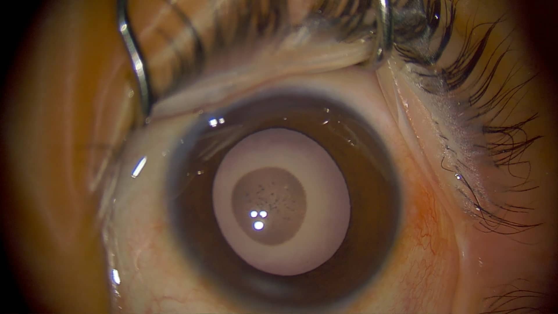 Surgery: Lens Aspiration in a Nuclear Lamellar Cataract: Dr. Jonathan ...