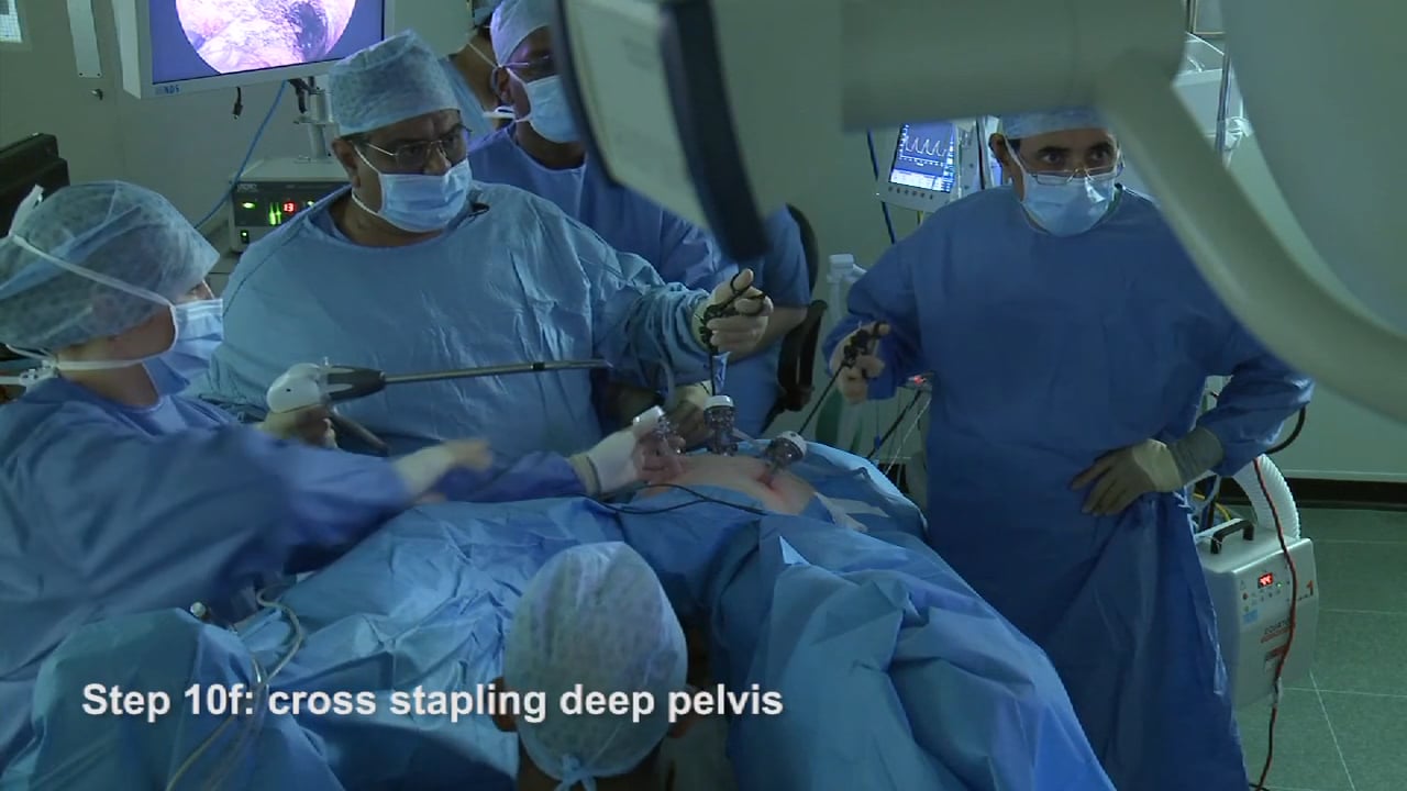 TME (Total Mesorectal Excision) on Vimeo