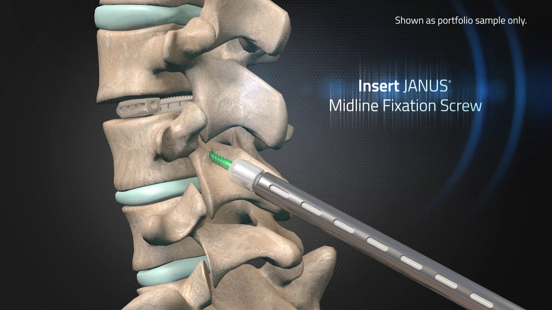 Midline Fixation Screw on Vimeo