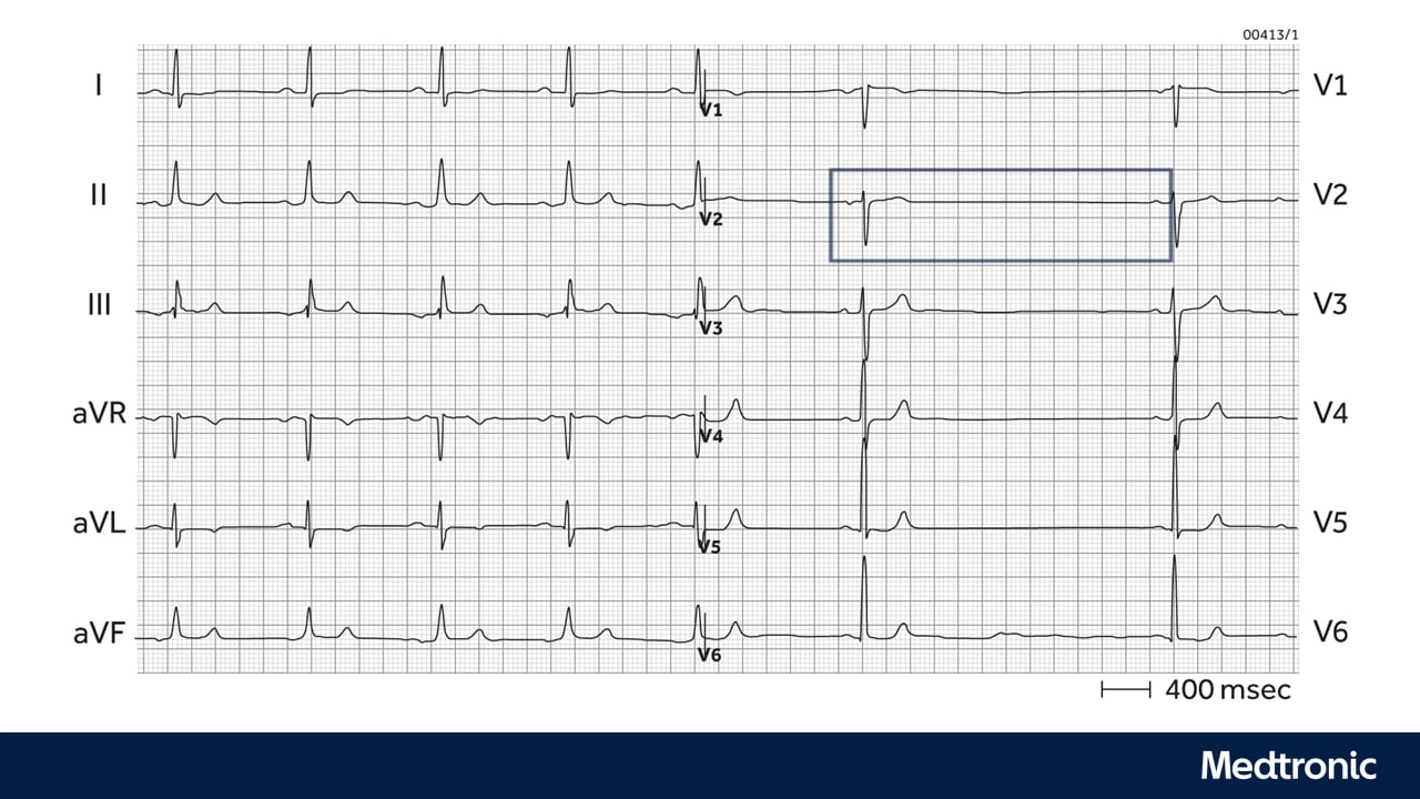 Friday Lecture - Medtronic Friday PART 1_SC 14b Sick SS ECG FIND - on Vimeo