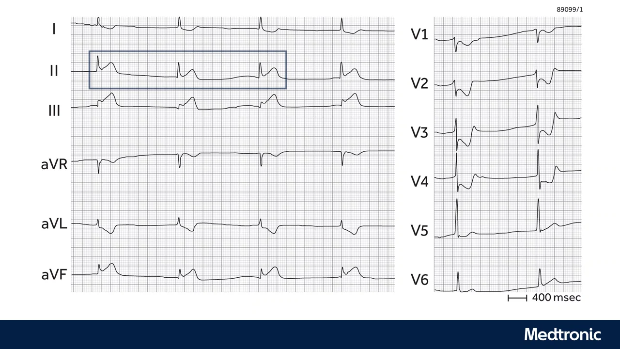 Friday Lecture - Medtronic Friday PART 1_SC 17 Sick SS ECG FIND_091818 ...