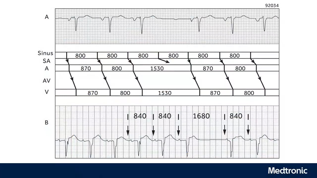 Friday Lecture - Medtronic Friday PART 1_SC 11 Sick SS ECG FIND_091818 ...