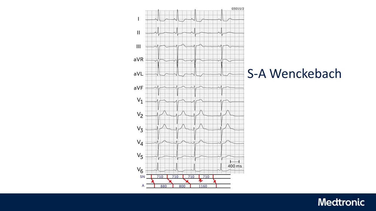 Friday Lecture - Medtronic Friday PART 1_SC 12 Sick SS ECG FIND_091818 ...