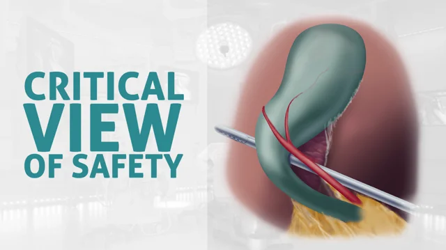 Laparoscopic Cholecystectomy Critical View