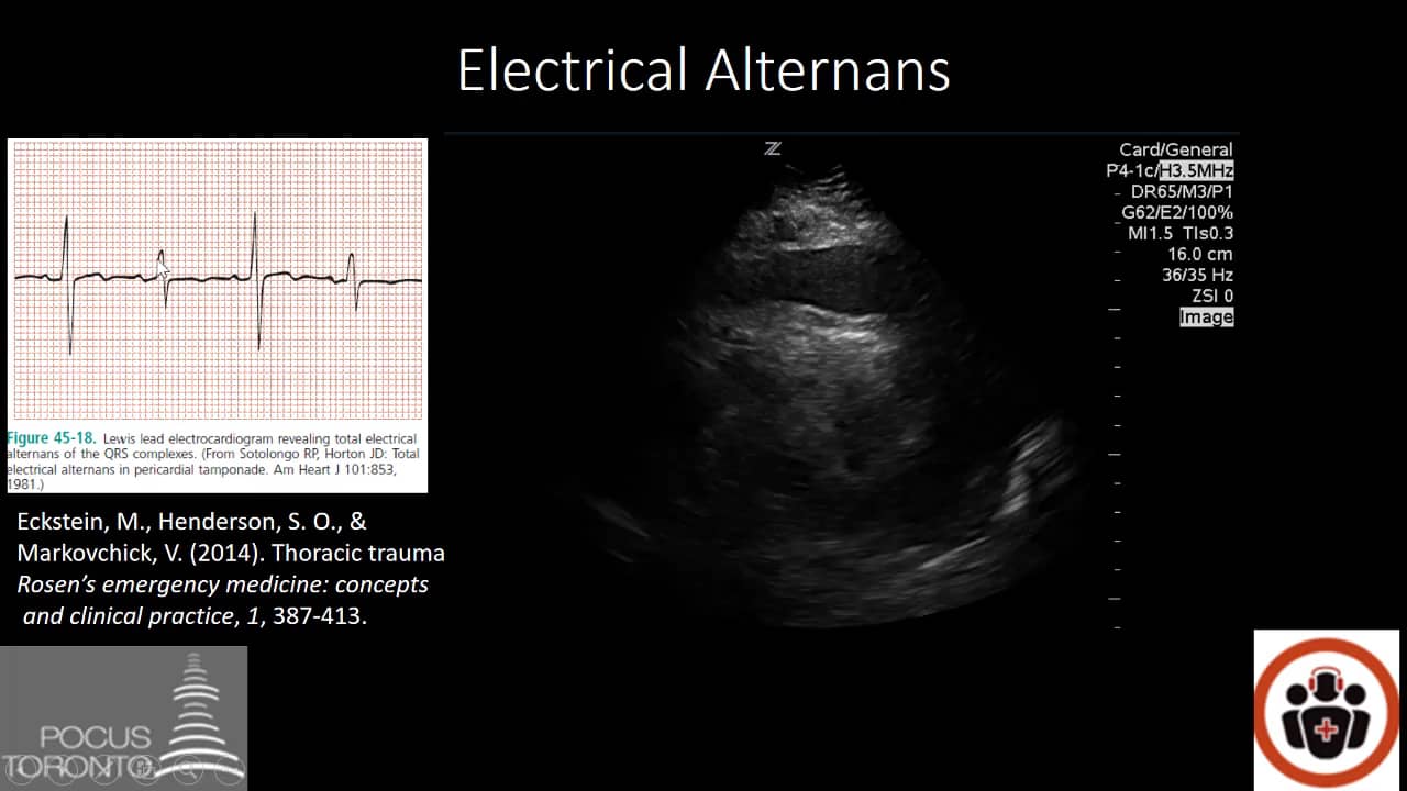 POCUS Cases 6 Pericardial Effusion on Vimeo