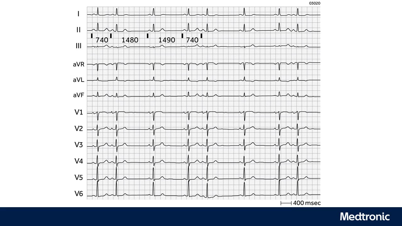 Friday Lecture - Medtronic Friday PART 1_SC 14a Sick SS ECG FIND_v2 on ...