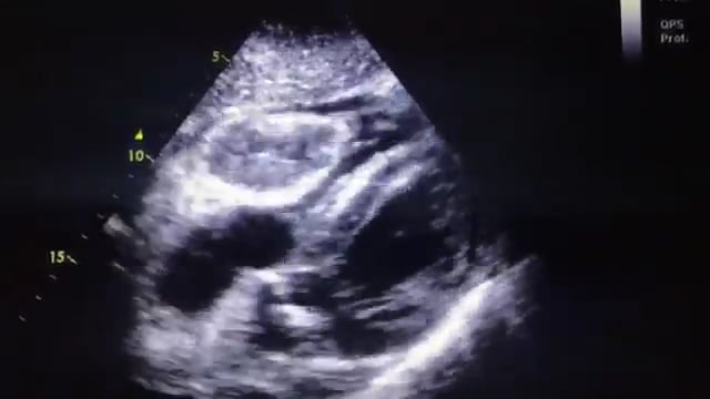 rpn_zyfFMPx1gOdV- RV clot Video on Vimeo