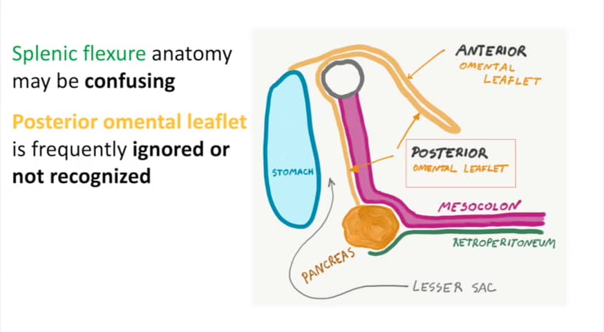 Splenic Flexure Anatomy, Inferior-Medial Approach, Lap Left for ...