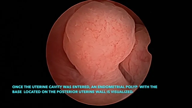 Hysteroscopy Polyp