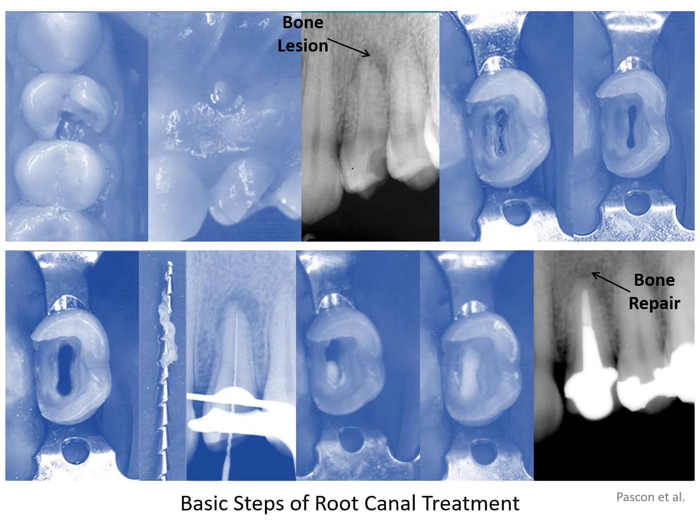 Endodontic applications of microcomputed tomography for studying root ...