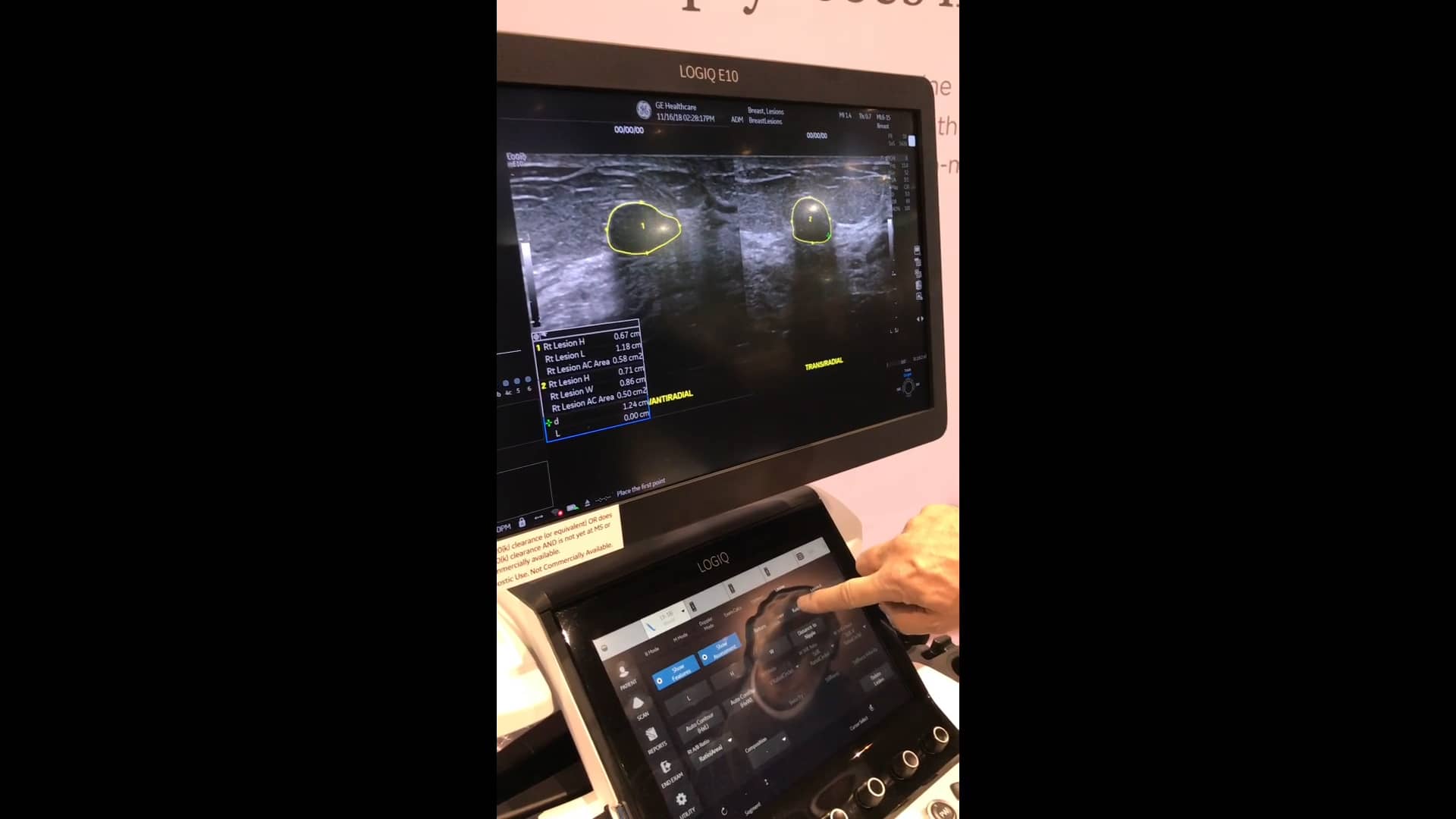 GE Healthcare LOGIQ E10 // Koios DS for Breast Integration on Vimeo