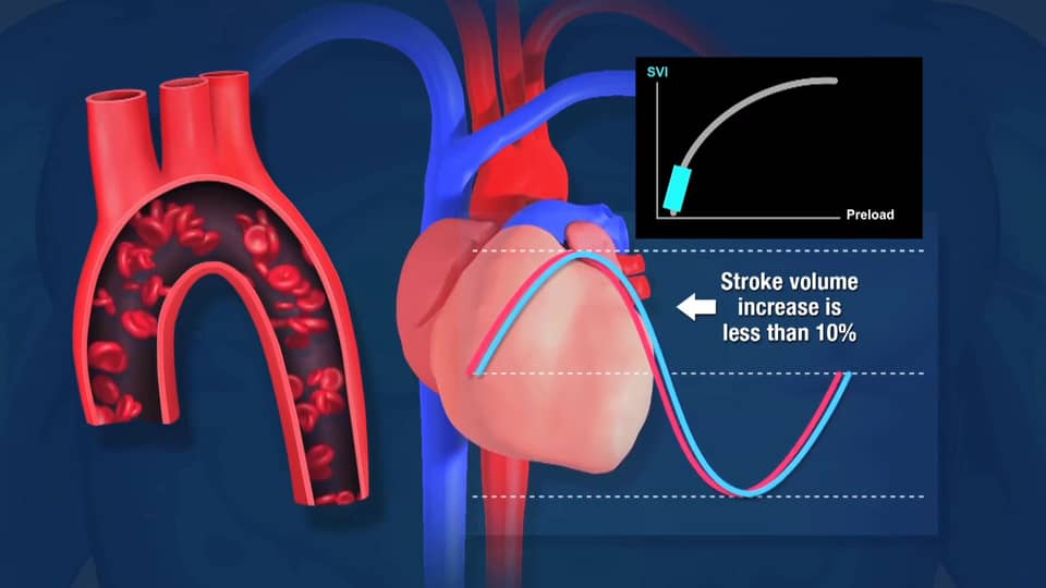 The CHEETAH STARLING SV Hemodynamic Monitoring System on Vimeo