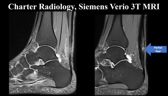 Achilles Tendon Tear Mri