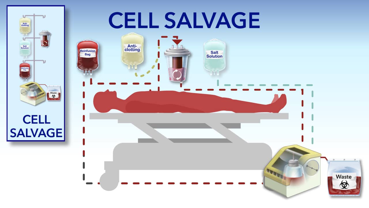 Cell Salvage and Hemodilution on Vimeo