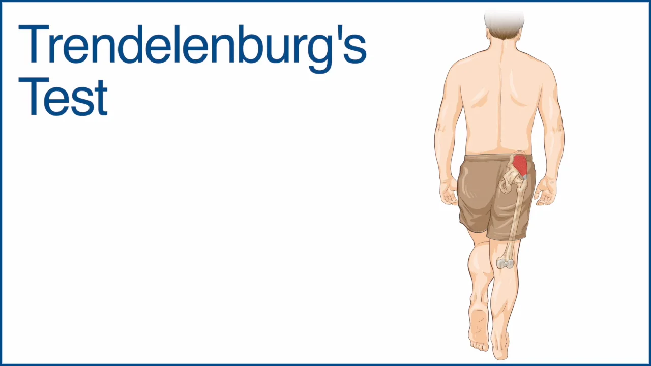 Trendelenburg Test For Varicose Veins