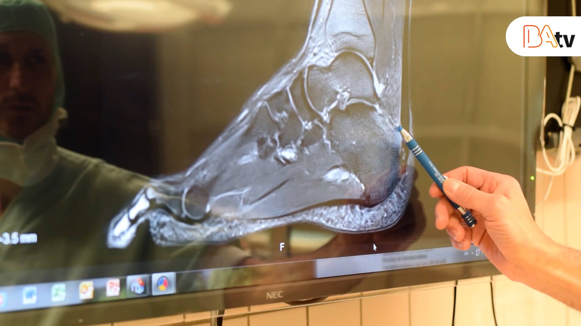 La maladie d'Haglund : Chirurgie on Vimeo