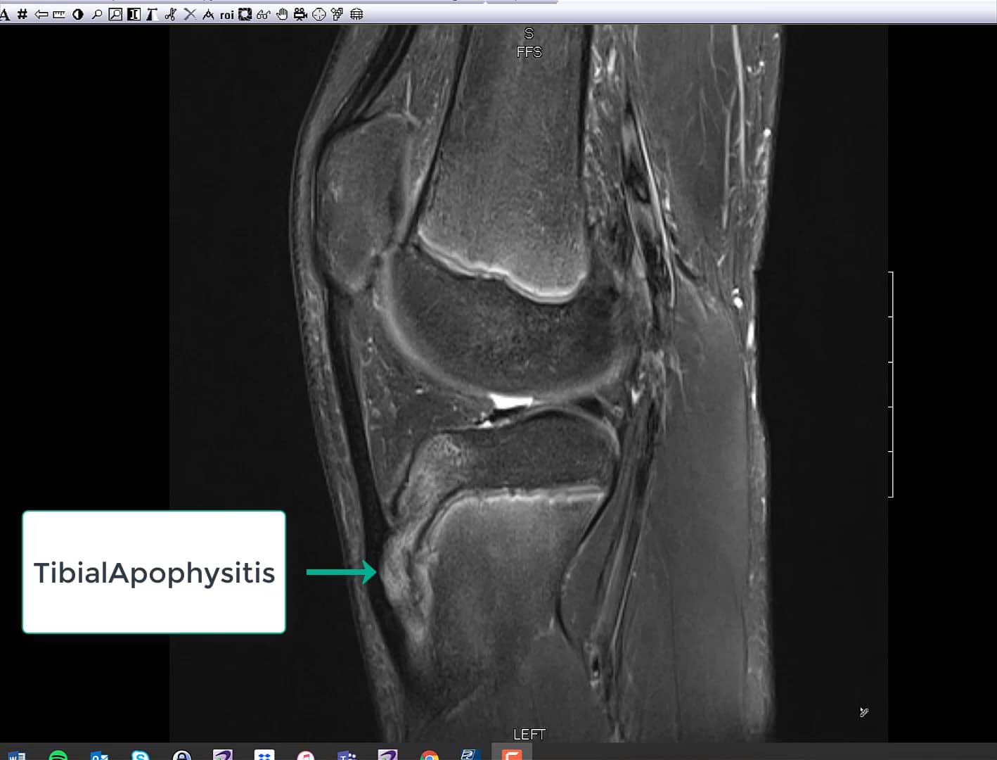 Tibial Apophysitis on Vimeo