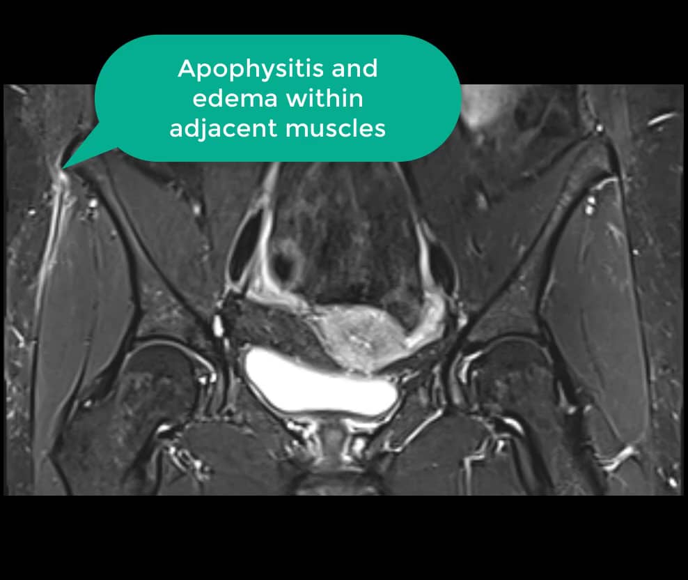 ASIS Apophysitis on Vimeo