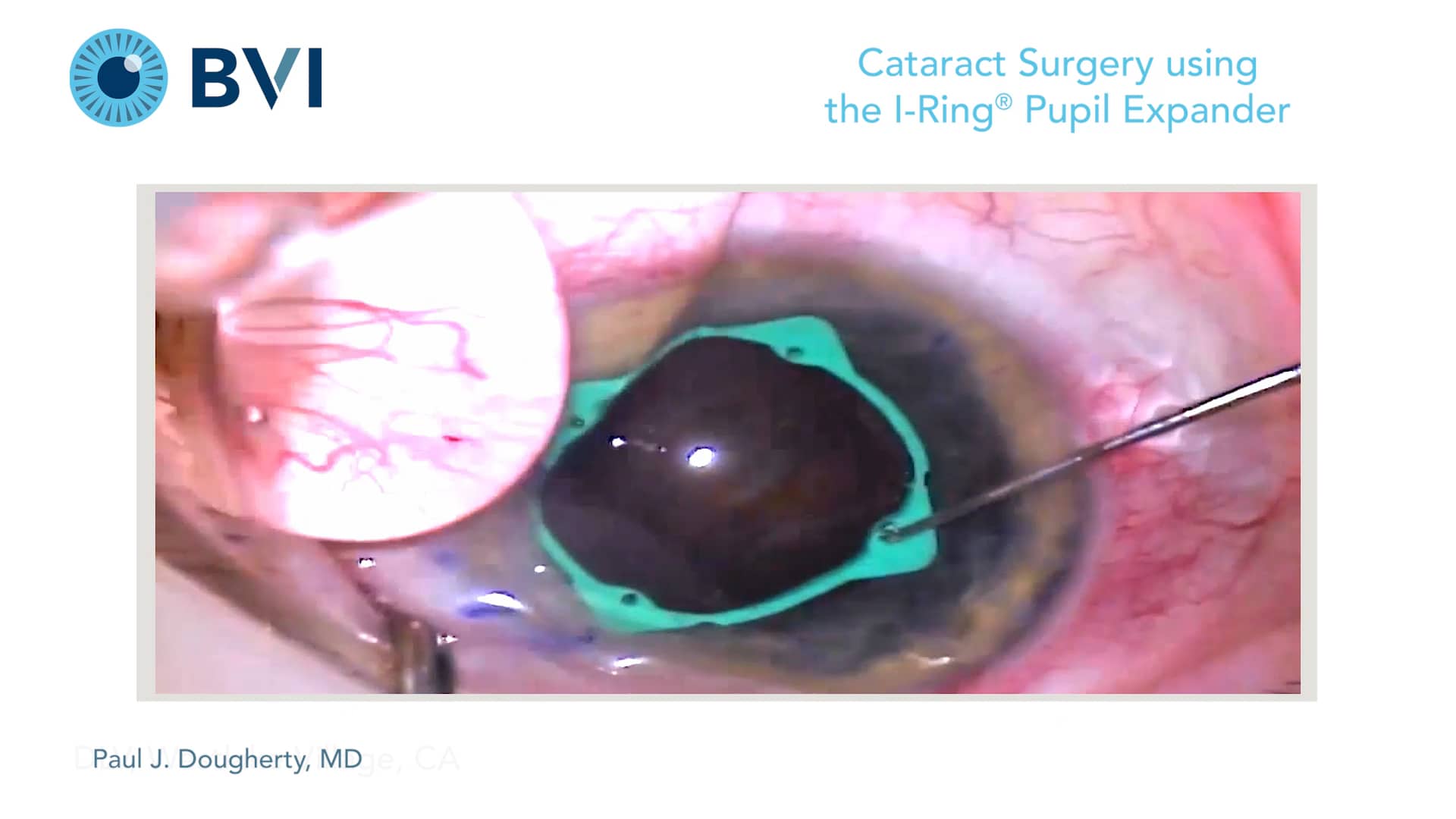 Cataract Surgery using the I-Ring Pupil Expander on Vimeo