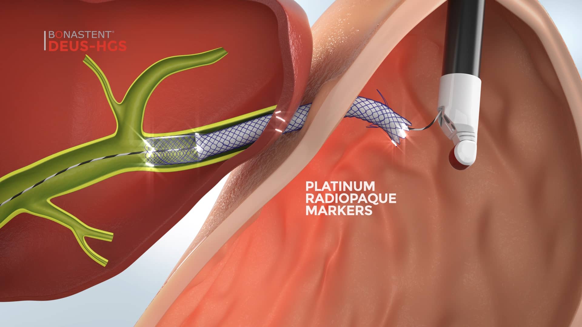 Bonastent® DEUS-Stent - Anwendungsvideo on Vimeo